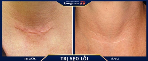 Trị sẹo lồi bằng công nghệ Ella- Xóa sạch sẹo lâu năm chỉ sau 1 lần