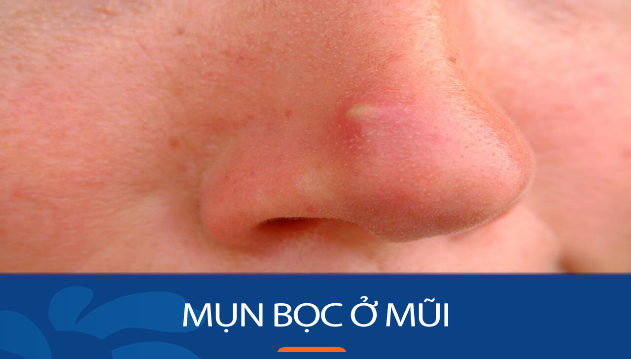 Mụn Bọc Mũi: Giải mã nguyên nhân & Bí quyết trị mụn DỨT ĐIỂM