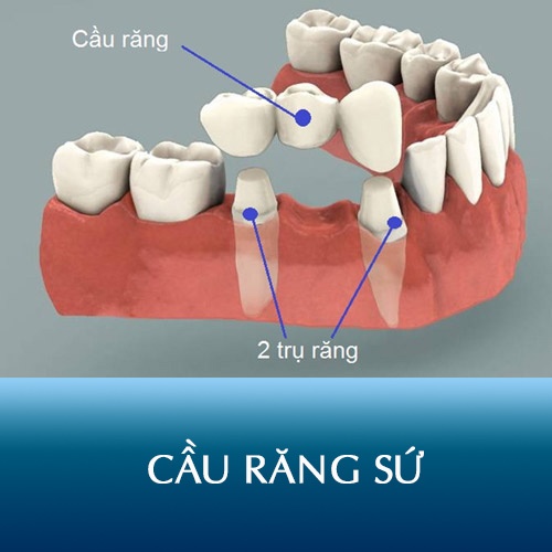 Cầu răng sứ 5S Kangnam - Giải pháp phục hình răng nhanh gọn