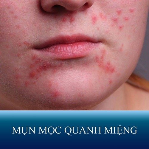 Mụn mọc quanh Miệng và Cằm ở Nữ, Nam giới là bệnh gì?
