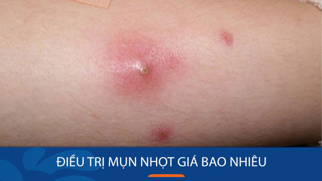 Cách điều Trị Mụn Nhọt ở Nách Bí Quyết Loại Bỏ Mụn Nhọt ở Nách Tận Gốc