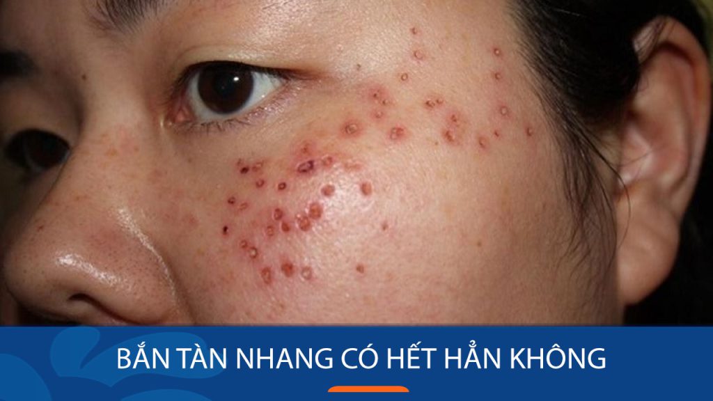 Bắn tàn nhang bằng laser - Lưu ý sau bắn laser loại bỏ tàn nhang