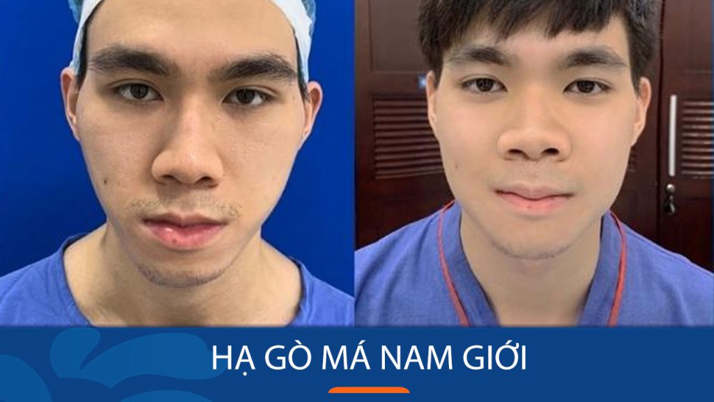 6 Bí quyết hạ gò má thon gọn, tự nhiên chỉ trong 7 ngày