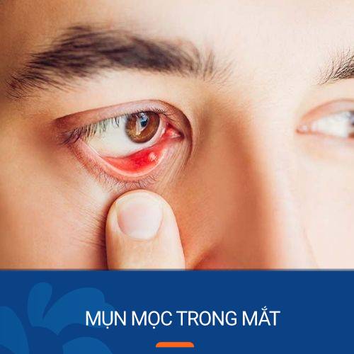 Mụn mọc trong mắt là do bị lẹo mắt, chắp mắt hay sạn vôi