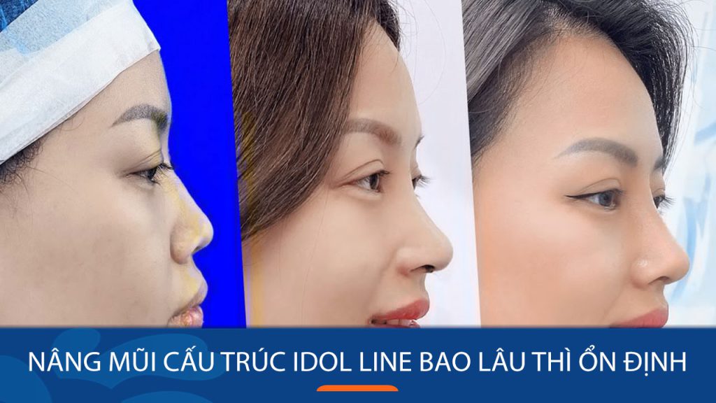 Nâng mũi cấu trúc Idol Line - Nâng là đẹp