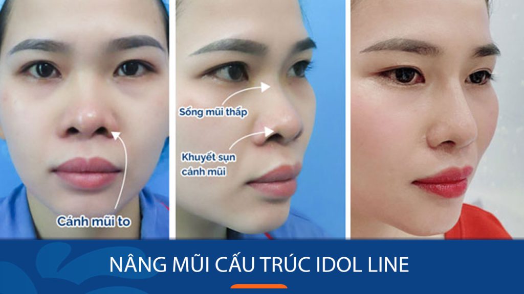 Nâng mũi cấu trúc Idol Line - Nâng là đẹp