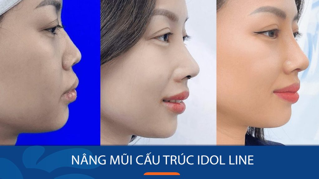 Nâng mũi cấu trúc Idol Line: Bí quyết sở hữu dáng mũi hoàn hảo như idol
