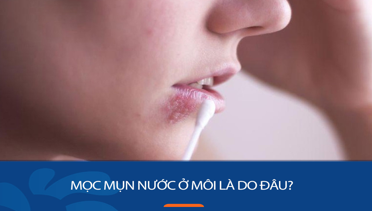 Mụn nước ở môi do herpes: Lây lan và phòng ngừa