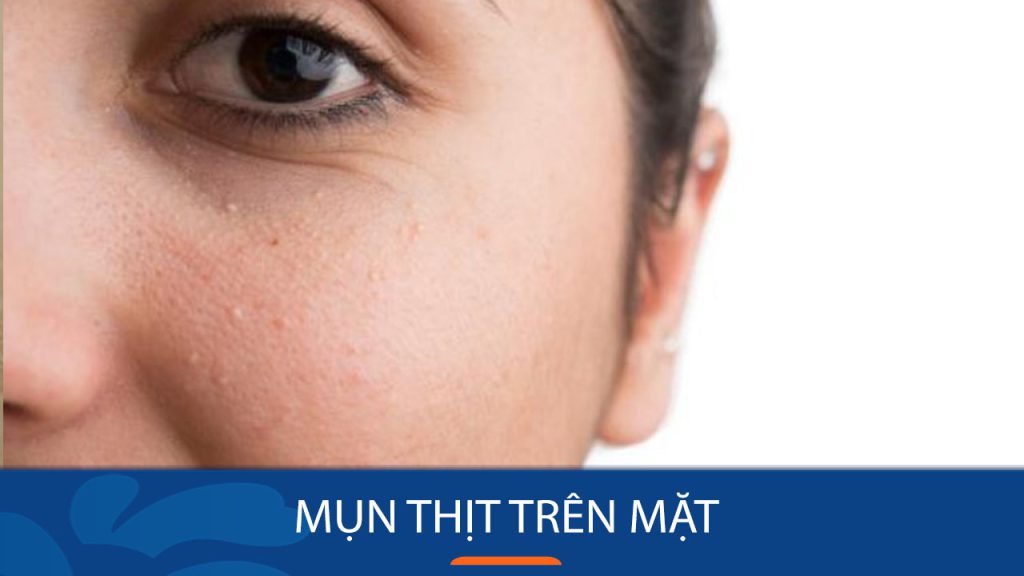 Kem trị mụn thịt có hiệu quả không? Review chi tiết