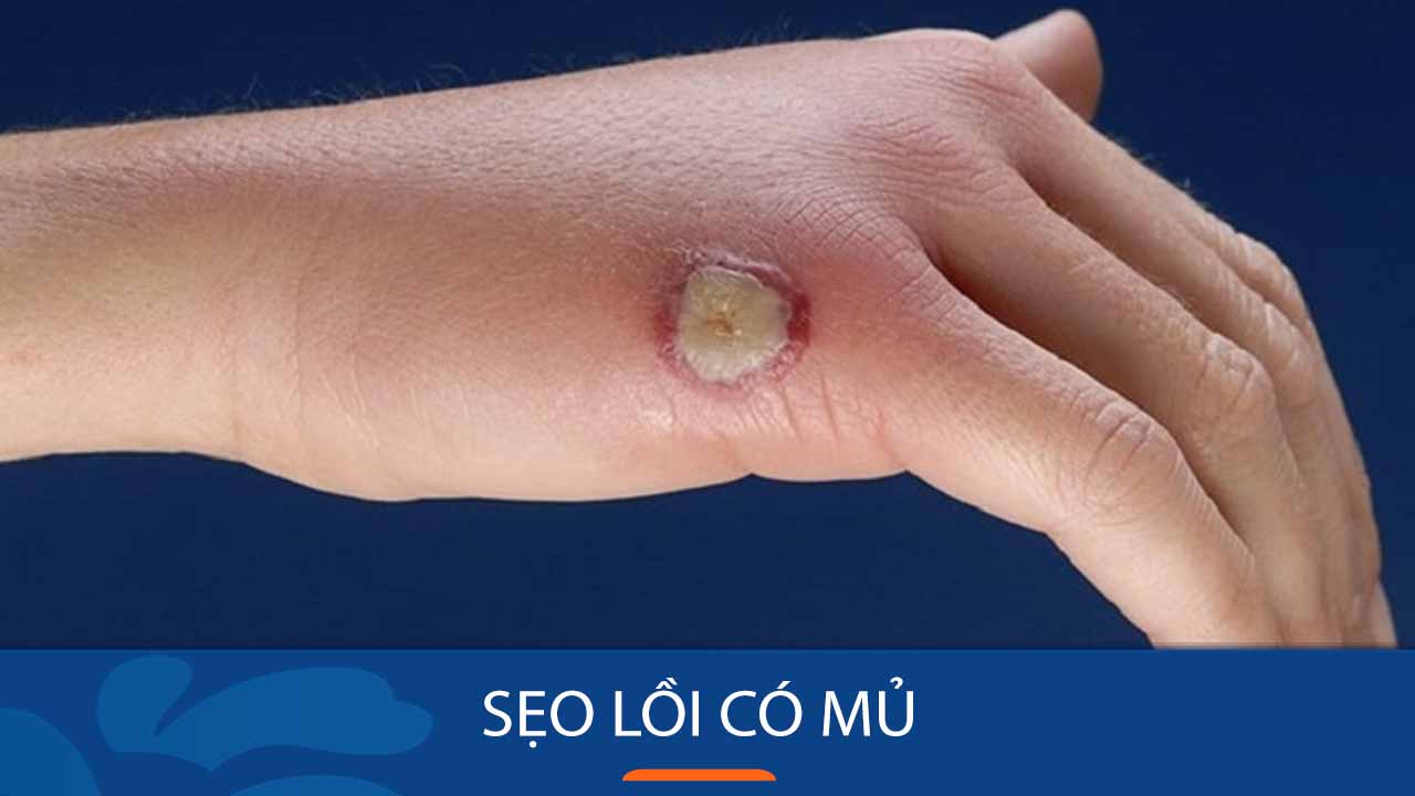 Sẹo lồi có mủ: Triệu chứng nguy hiểm và các phương pháp điều trị an toàn