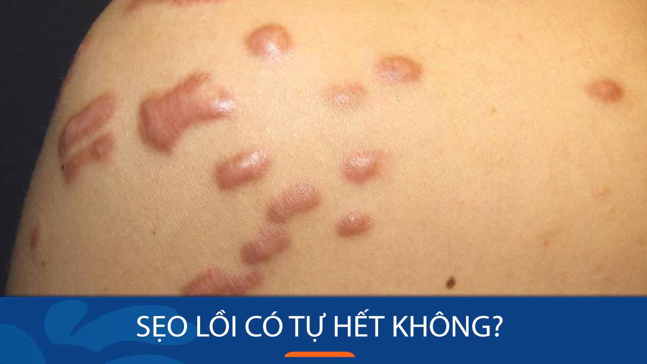 Sẹo lồi có tự hết không? Loại bỏ hoàn toàn hay chỉ có thể cải thiện?