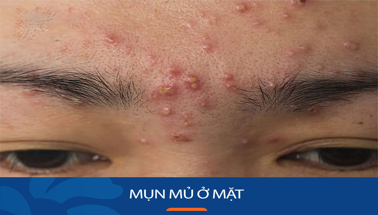 Mụn mủ ở mặt: Cách trị mụn mủ ở mặt hiệu quả NHẤT trong 7 ngày