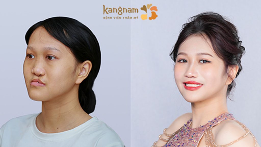 Từng trải qua 8 cuộc phẫu thuật, Xuân Mai chỉ thực sự "lên đời" nhan ...