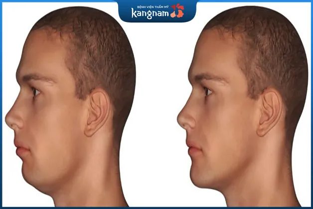 Mewing: bài tập chuẩn y khoa và những điều cần biết